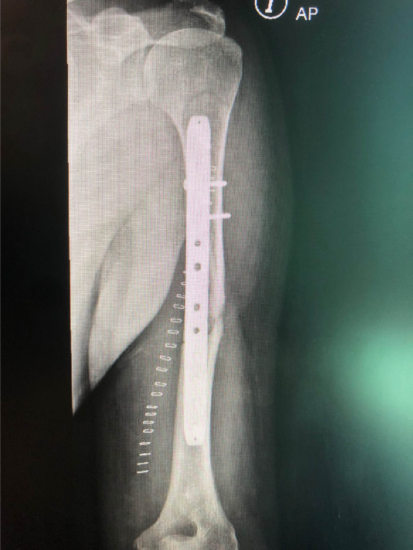 AP post OP Fx húmero 2 | Dr. Gerardo Lavalle